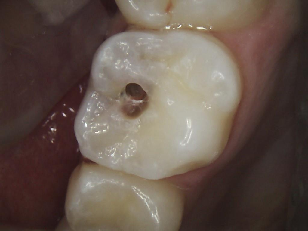 Dark Tooth | Chicago Style Smiles