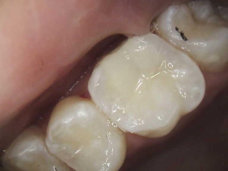 Dark Tooth | Chicago Style Smiles